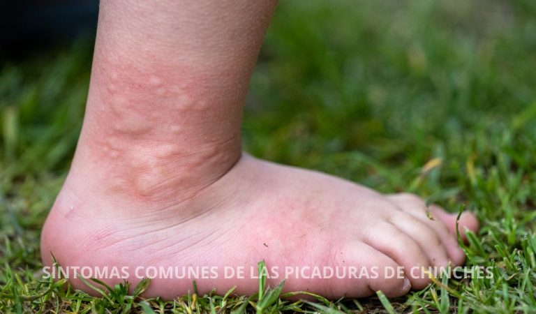 ¿Cómo son las picaduras de chinches? | Signos más comunes